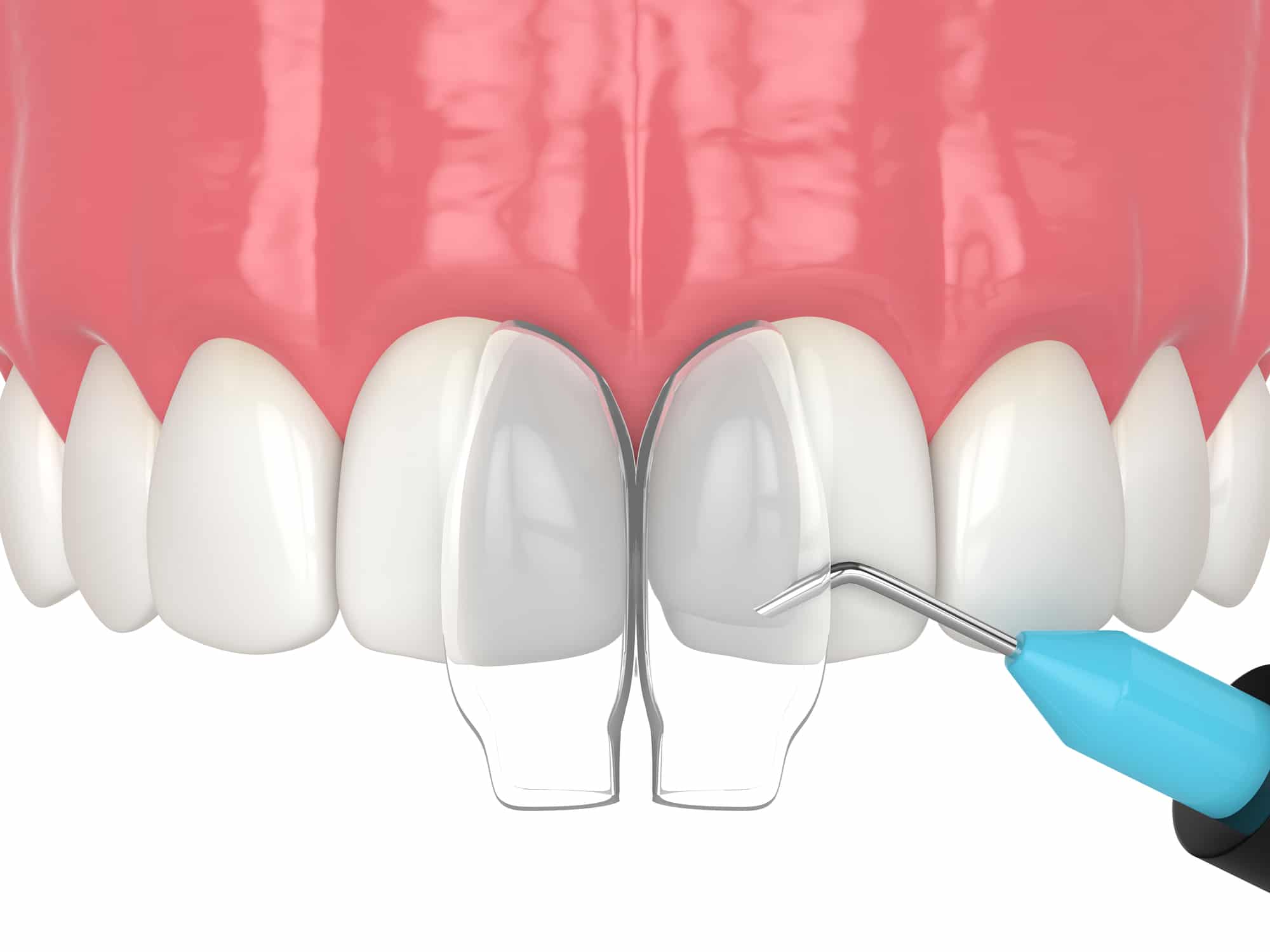 Veneers - Sunshine Coast Cosmetic Dental Clinic