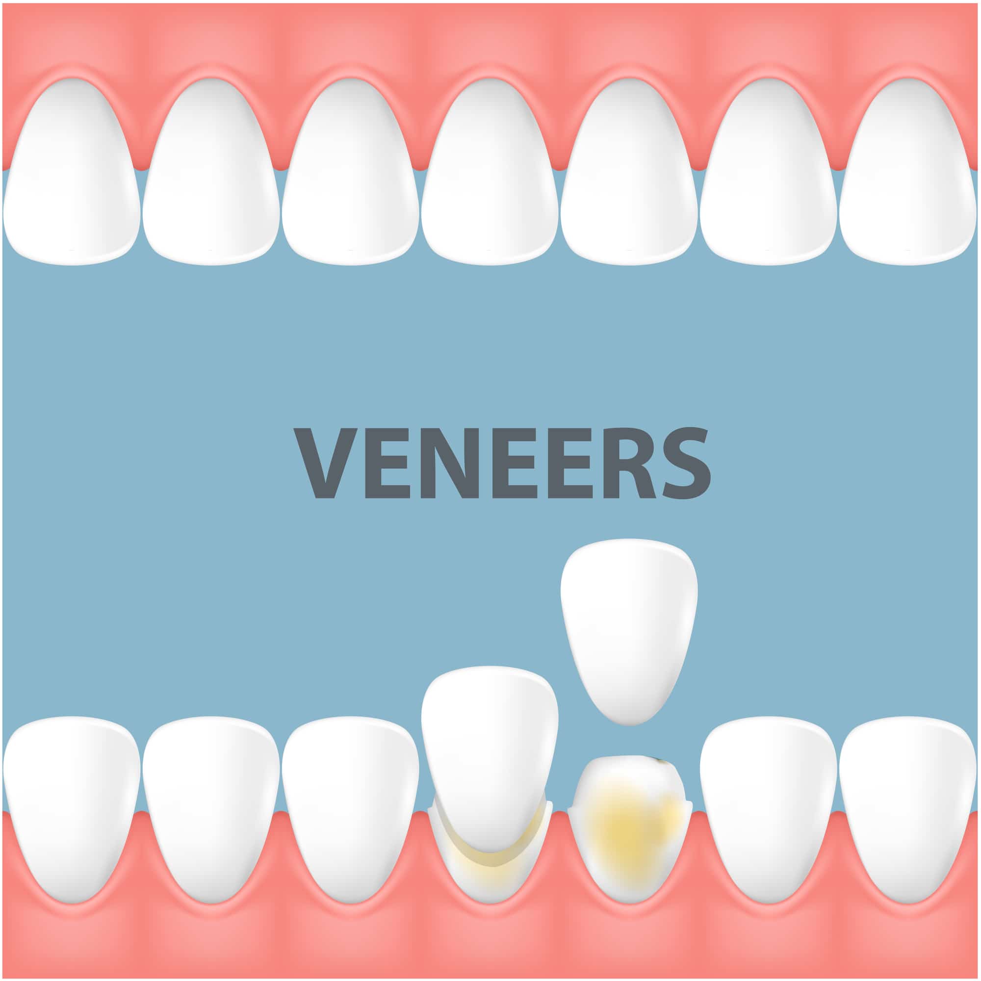 Veneers - Sunshine Coast Cosmetic Dental Clinic